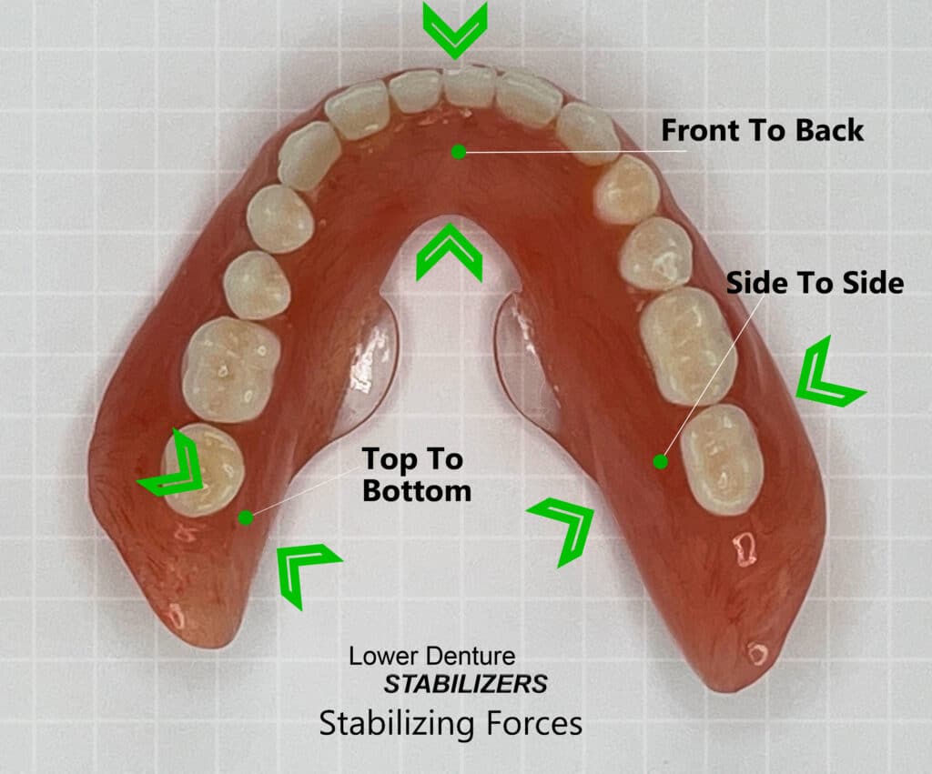 Lower Denture Stabilizers-The Adhesive Alternative-Stabil-Dent