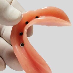 Dental Implants Are Incomplete Without Denture Stabilizers