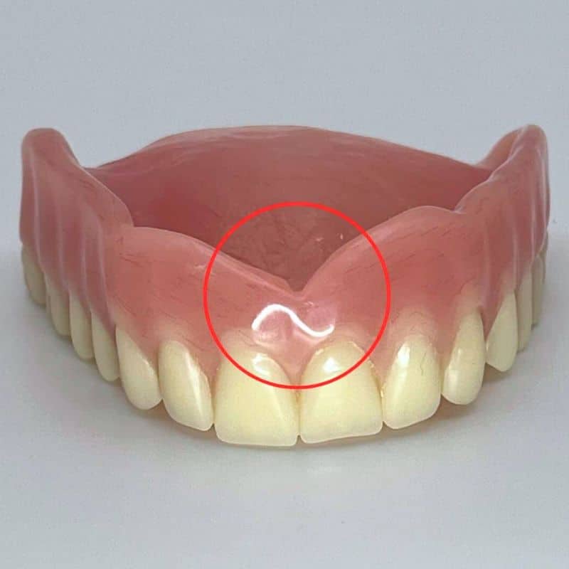 Troubleshooting Denture Problems